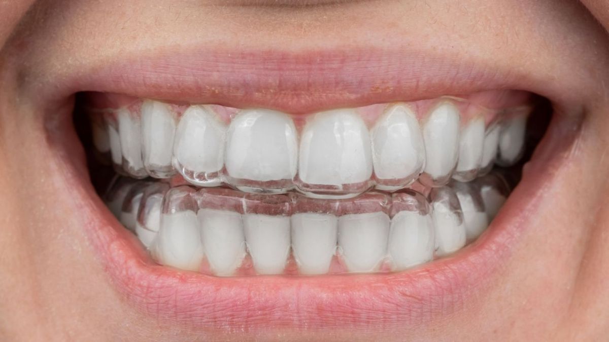 Alinhadores Ortodônticos Invisíveis: Como funciona?