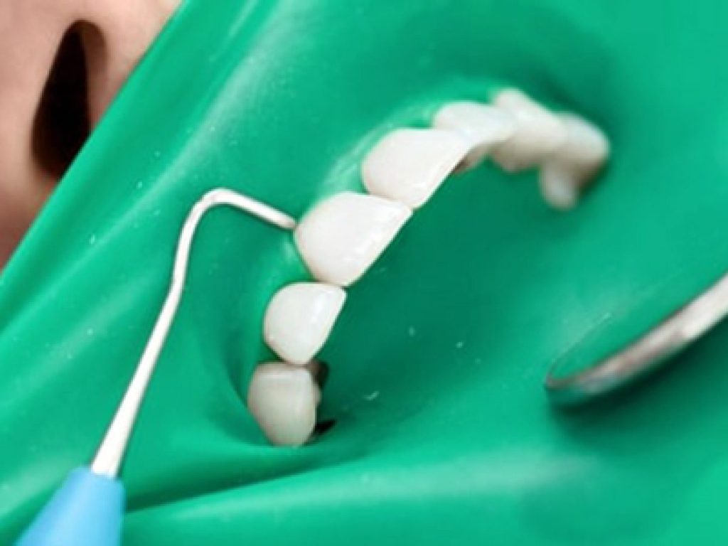 Isolamento Absoluto na Odontologia: Como Funciona?