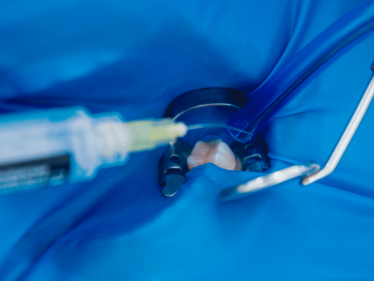 Isolamento Absoluto na Odontologia: Como Funciona?