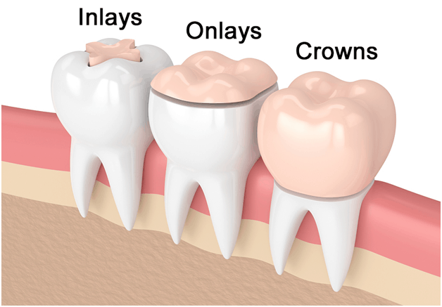 Tudo O Que Você Precisa Saber da Restauração Onlay e Inlay!