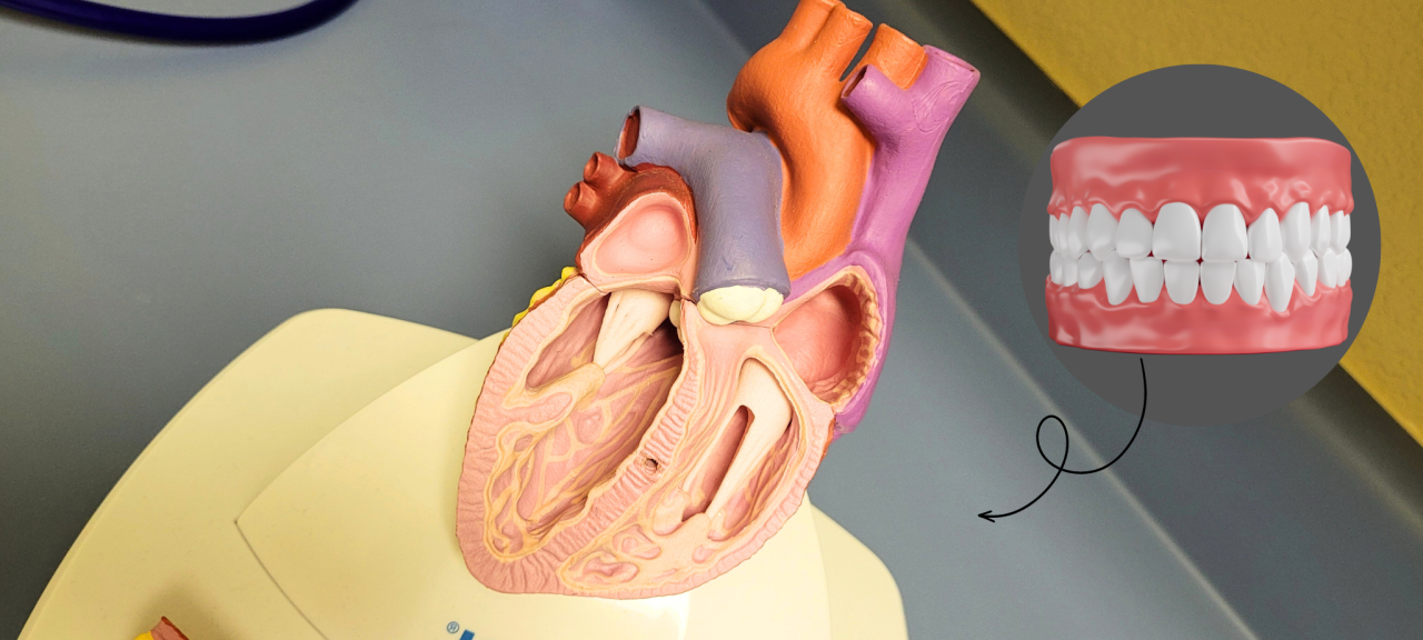 O que é a Endocardite Bacteriana na Odontologia?