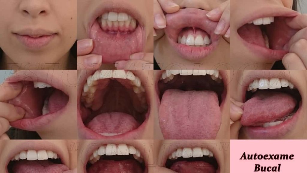 Câncer de Boca: Veja Sintomas, Diagnóstico e Tratamento