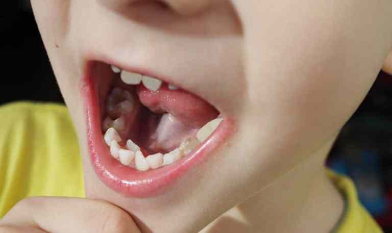 Hiperdontia: Causas e Tratamento para Dentes a Mais na Boca