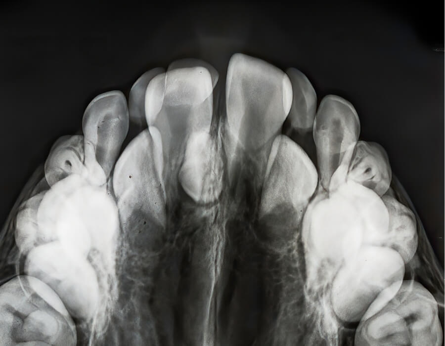 Raio X De Hiperdontia Have You Ever Seen Teeth Like This Before?