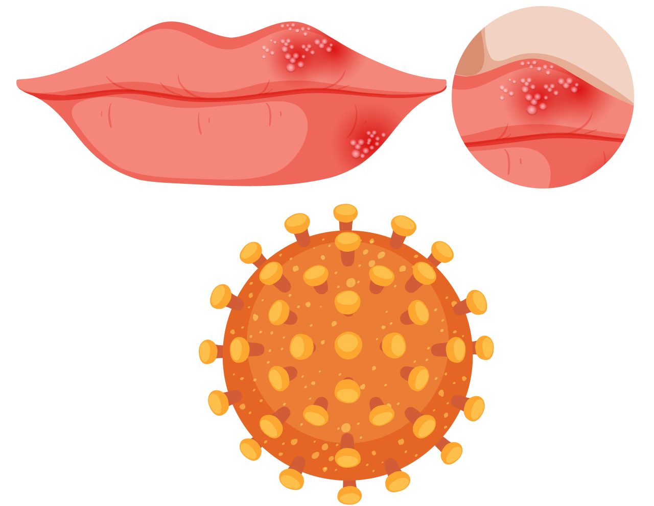 Herpes Labial: Dúvidas sobre Causas e Tratamentos • EAPGOIAS