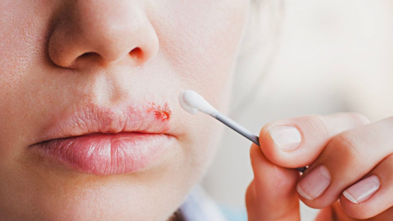 Herpes No Labio Superior Herpes Labial: Sintomas,causas E Tratamento