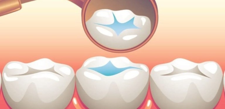 Selante Dental: O que é e como aplicá-lo?