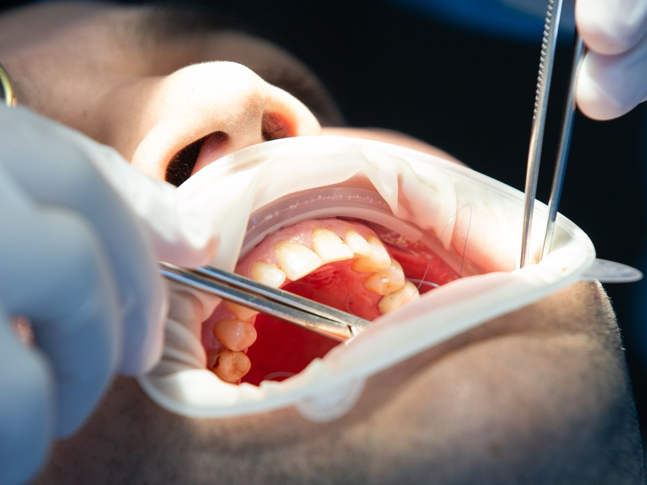 Abscesso Dental: O que é, Causas e Tratamento