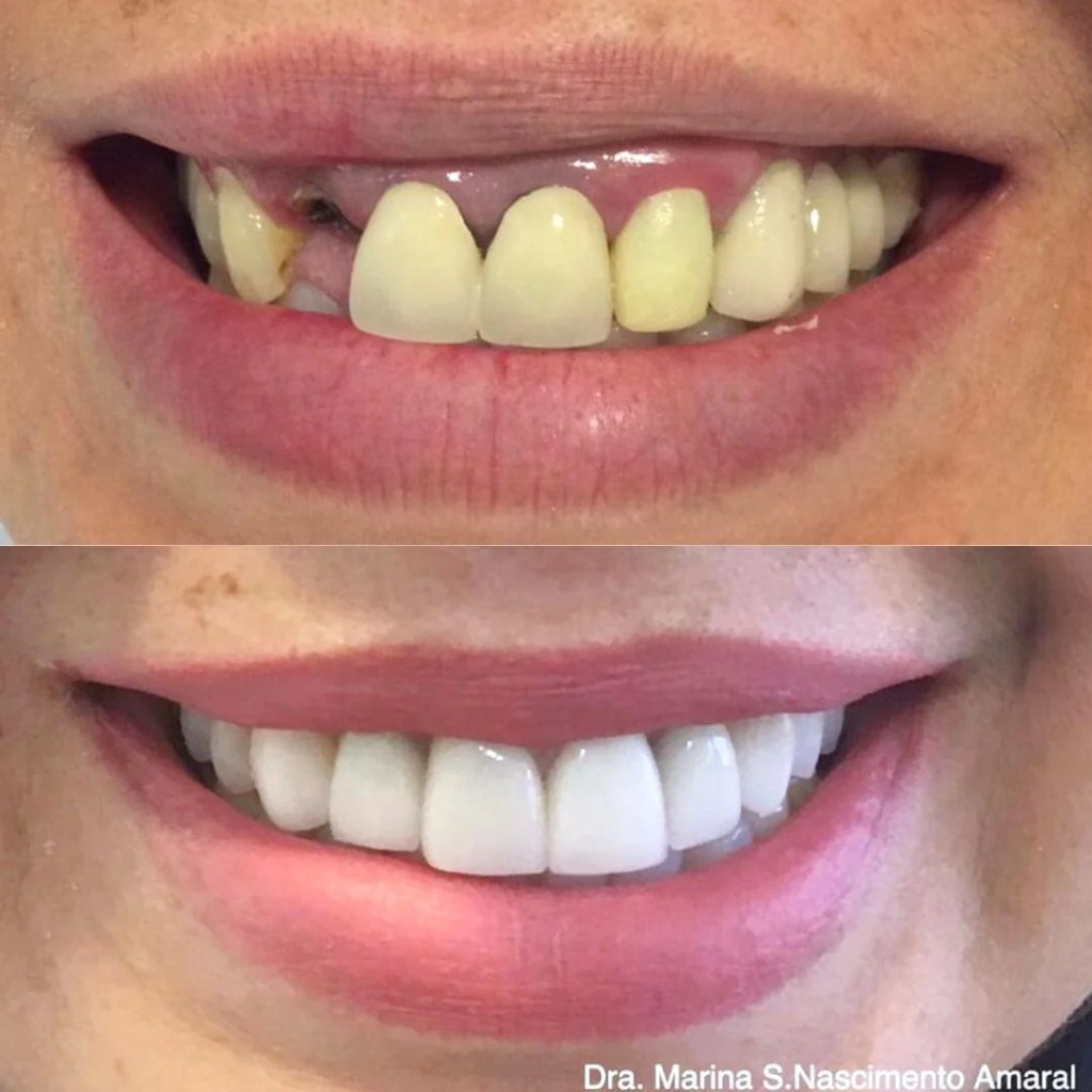 Dente Provisório: O que você precisa saber desse implante?
