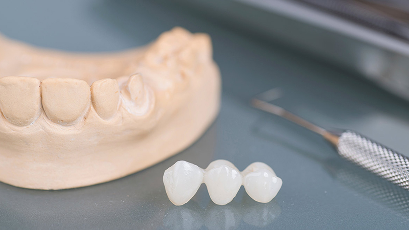 Dente Provisório: O que você precisa saber desse implante?