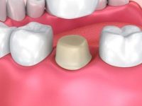 Dente Provisório: O que você precisa saber desse implante?