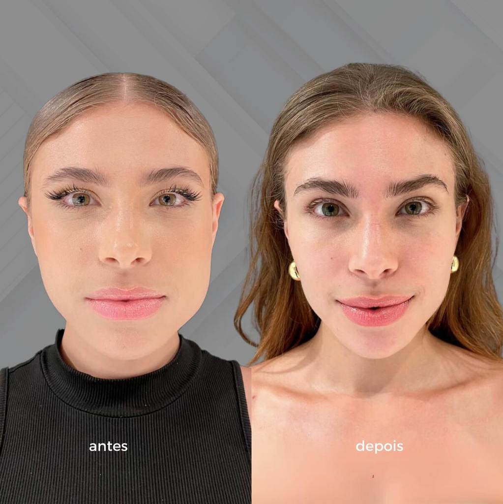 Assimetria Facial: Conheça 5 Principais Tratamentos