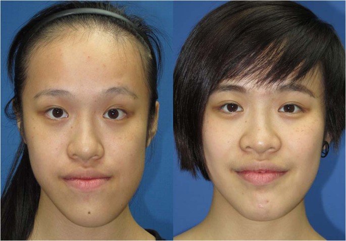 Assimetria Facial: Conheça 5 Principais Tratamentos