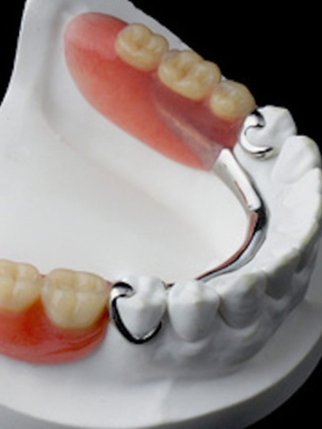 Prótese com Grampos: Como escolher a PPR?