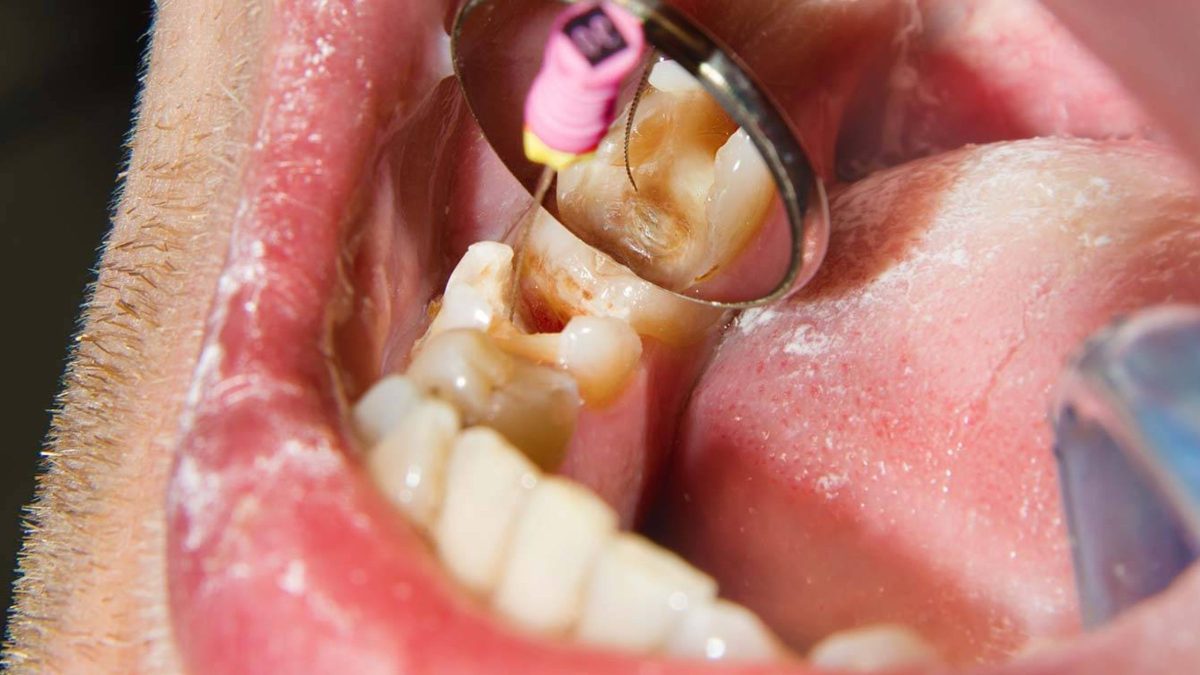 Curetagem Pulpar: O que é esse Tratamento?