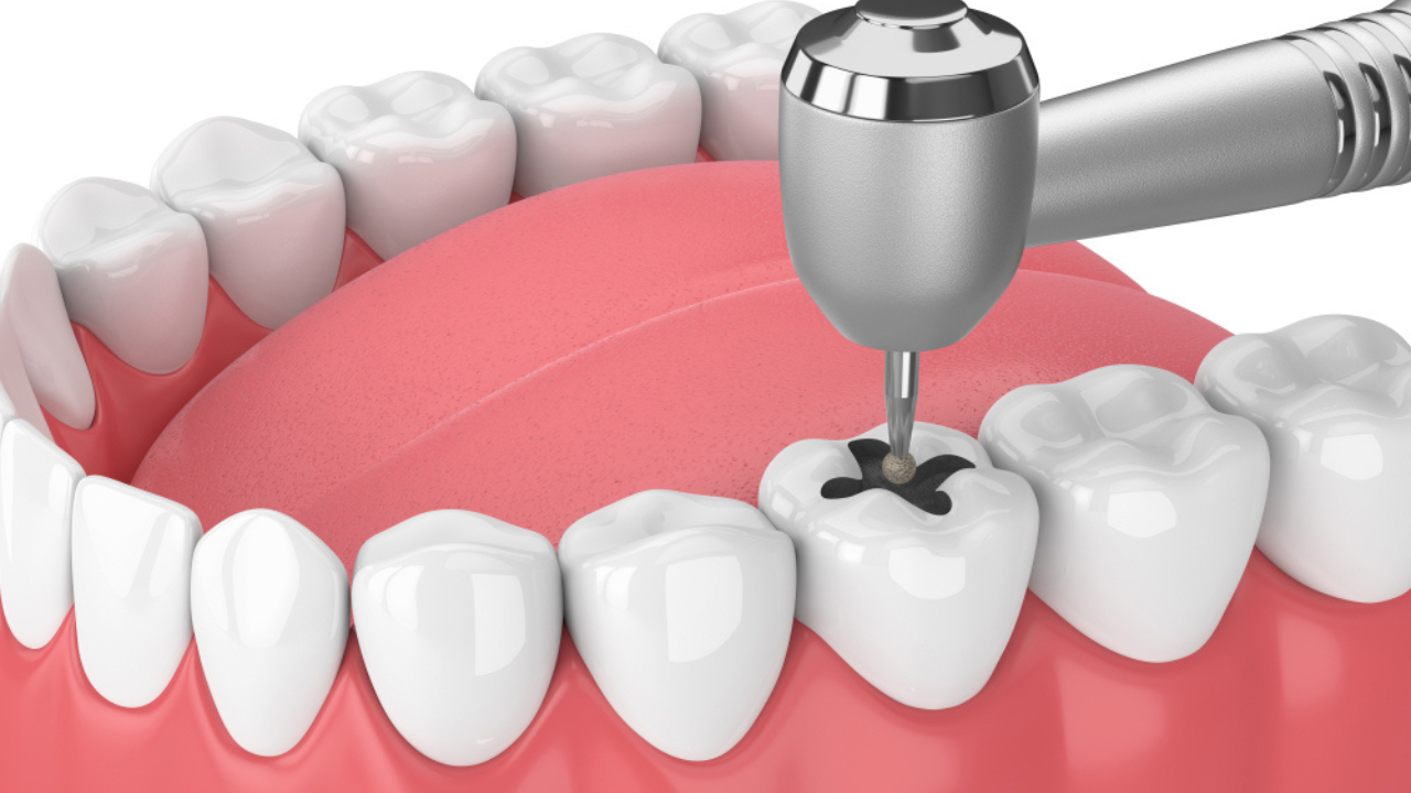 Curetagem Pulpar: O que é esse Tratamento?