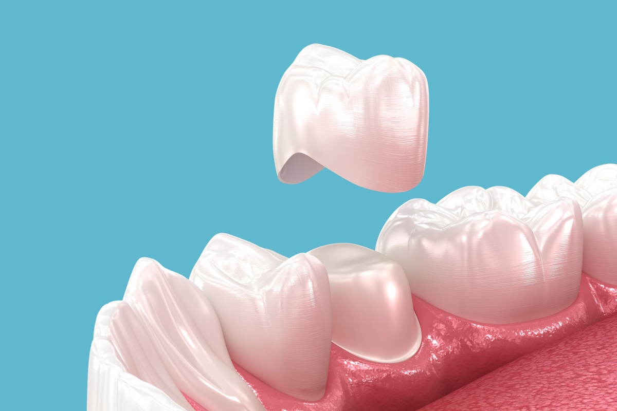 Coroas Dentárias: 6 Tipos e O que Você Precisa Saber!