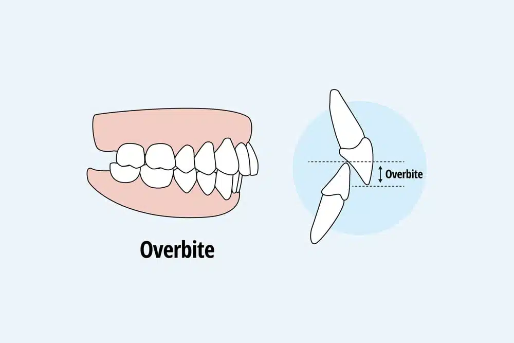 Overjet e Overbite: Quais as Diferença das Más Oclusões?